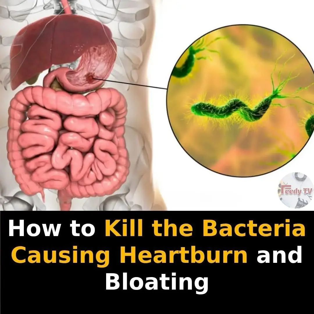 How to treat H. Pylori Bacteria Causing Heartburn And Bloating ...