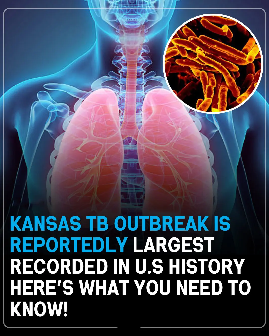 Kansas TB Outbreak Is Reportedly Largest Recorded In US History