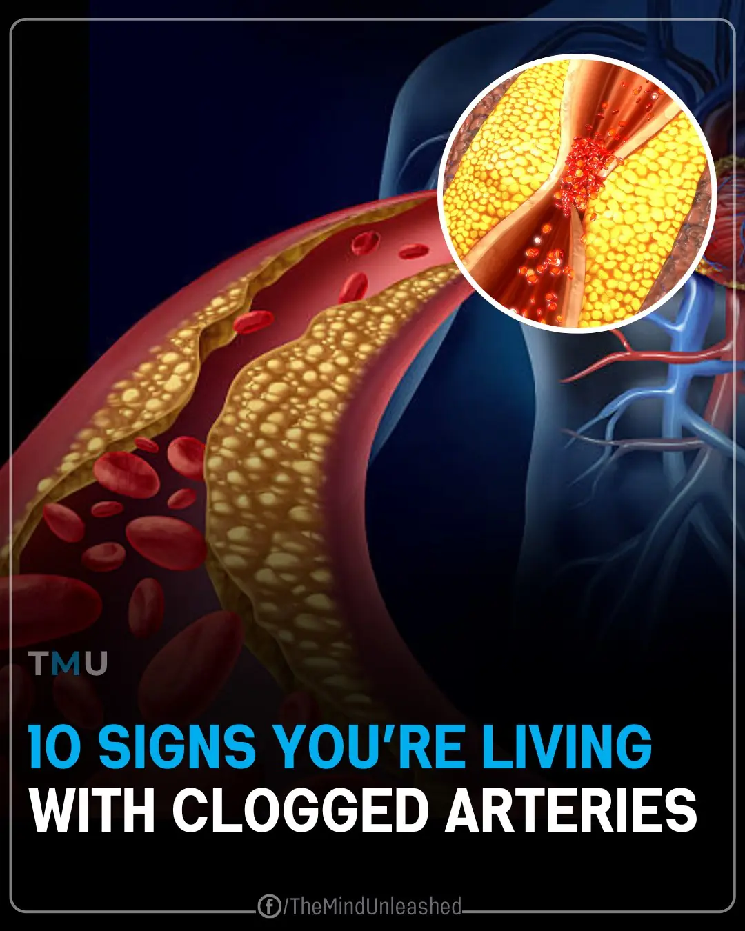 10 Signs You’re Living With Clogged Arteries