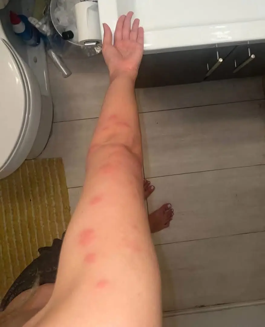 Bug Bite Identification: 10 Common Bug Bites With Pictures