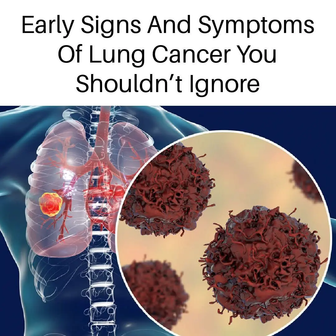 20 Early Warning Signs of Lung Cancer That People Should Never Ignore