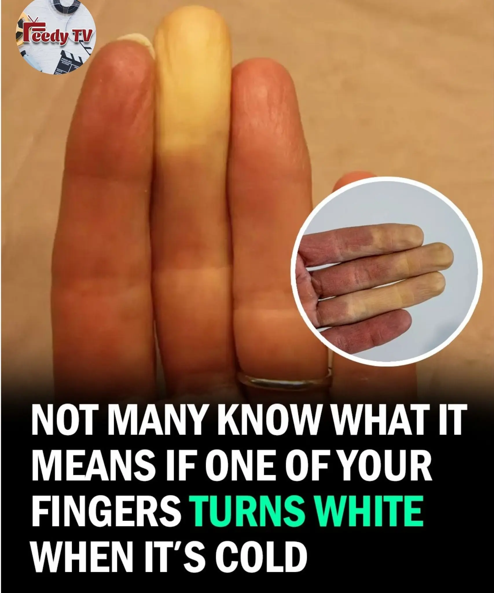 Rare Disorder Can Turn Fingers, Toes White or Blue When it’s Cold