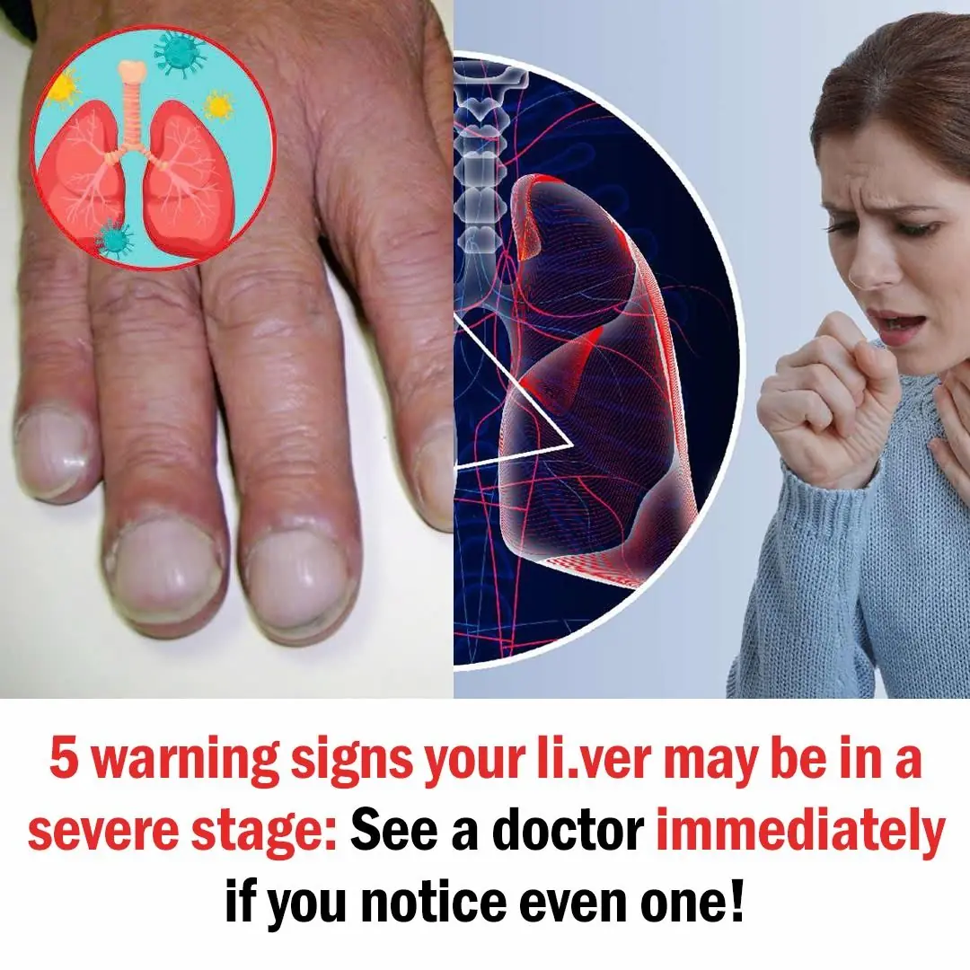 Bruise easily? Itchy skin? 5 signs you have liver damage without even ...