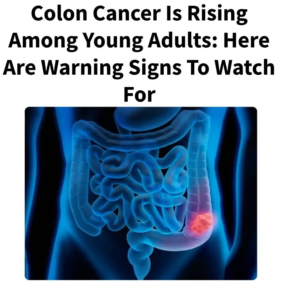 10 Warning Signs of Bowel (Colorectal) Cancer You Shouldn’t Ignore