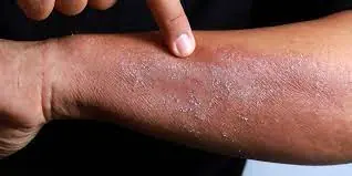 How To Get Rid Of Eczema: 13 Natural Remedies Backed By Research