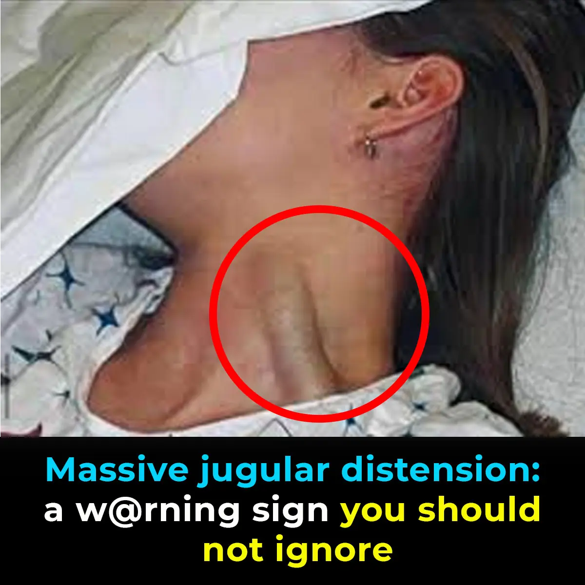 Massive jugular vein distension: a warning sign you shouldn’t ignore