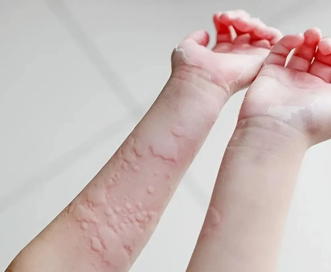 Unexpected Causes of Hives: What’s Really Behind Your Skin Flare-Ups