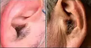 Did You Know Ear Hair Growth May Reveal This About Your Health?