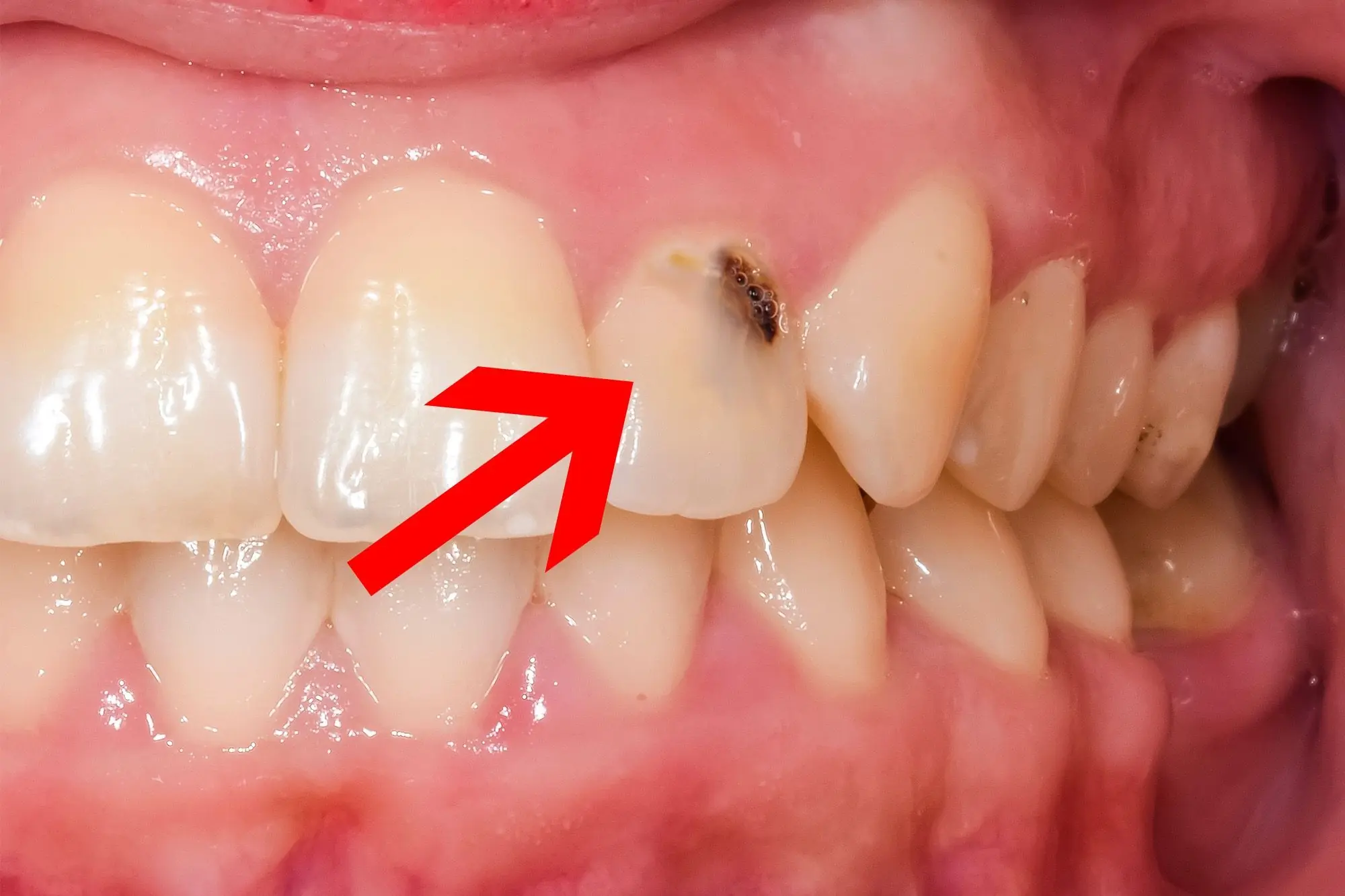 Natural Ways to Prevent Cavities and Strengthen Your Smile