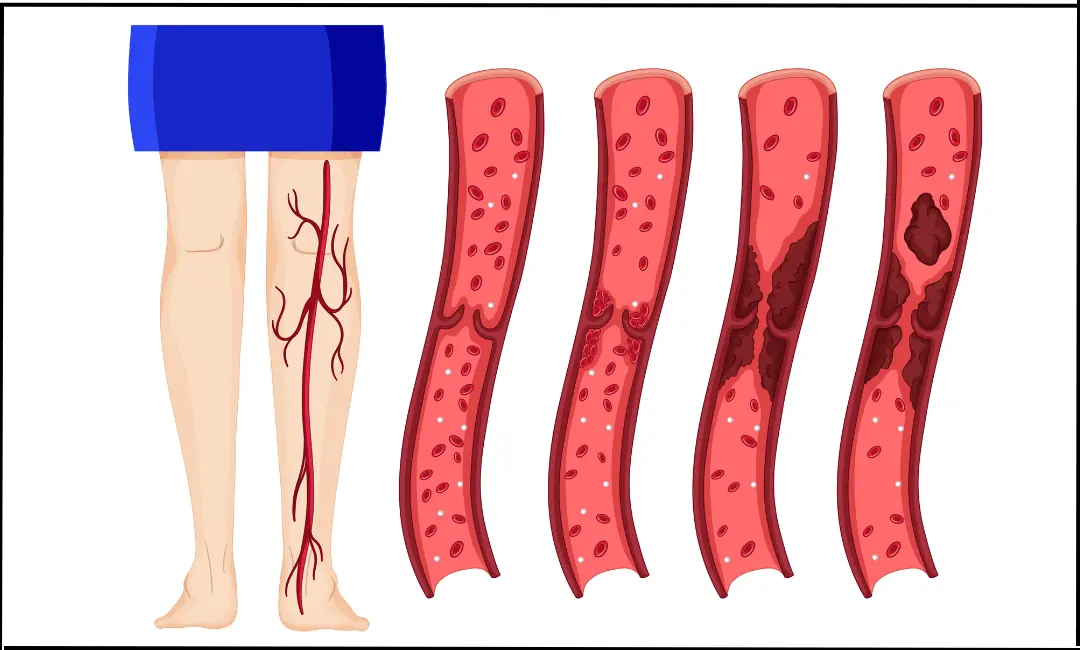 Know the Signs: What a Blood Clot in Your Leg Looks and Feels Like