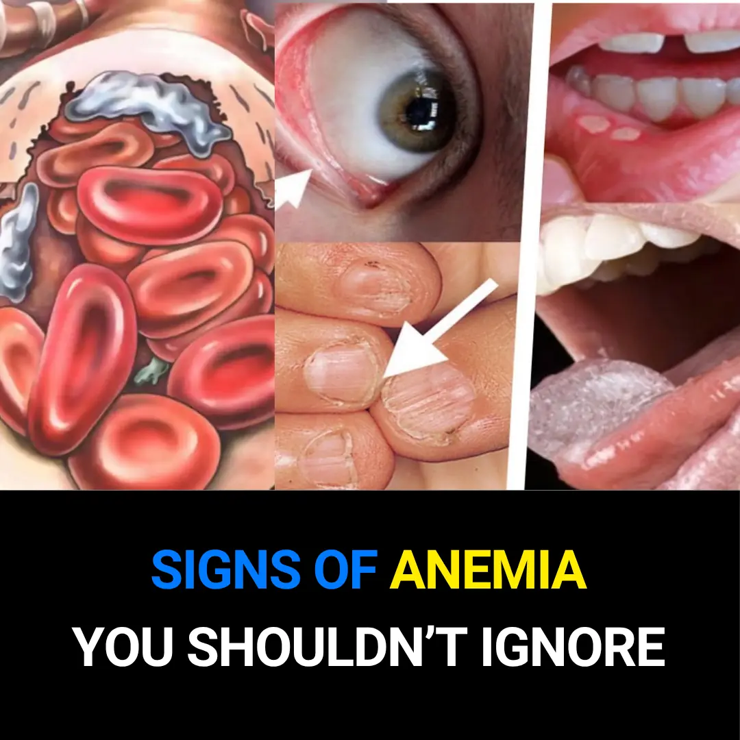 Silent Symptoms of Anemia You Should Never Ignore