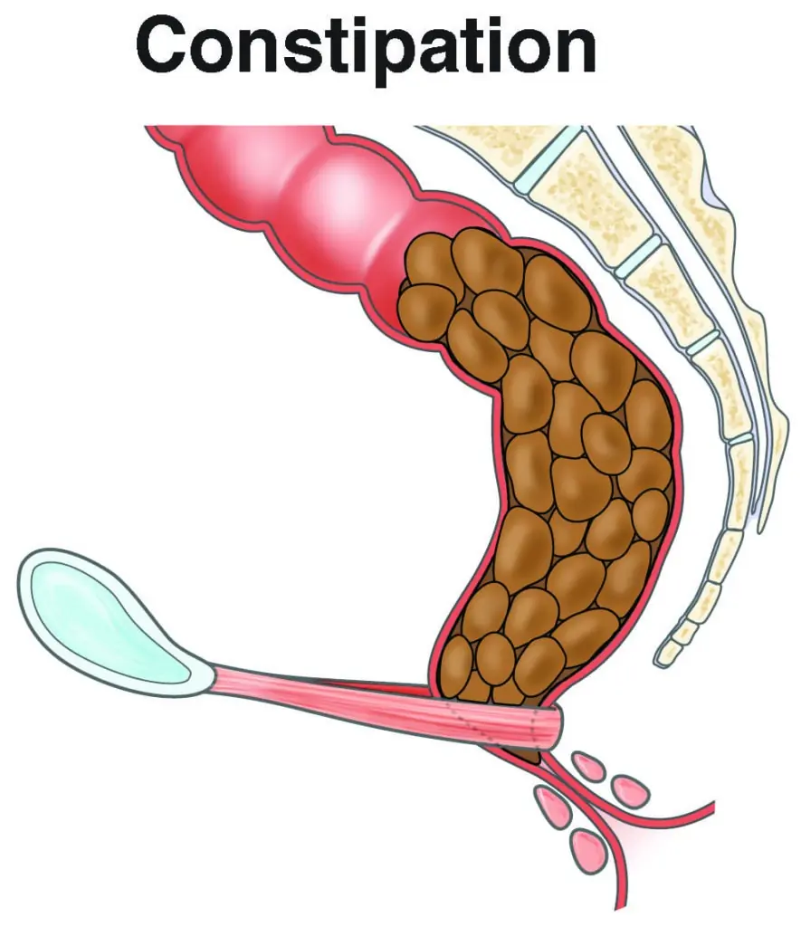 Here's How to Quickly Empty Your Bowels and End Constipation