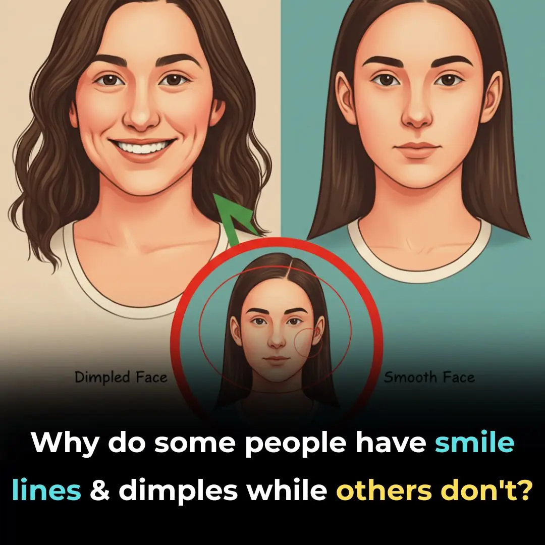 Why Do Some People Have Smile Lines and Dimples While Others Don’t?