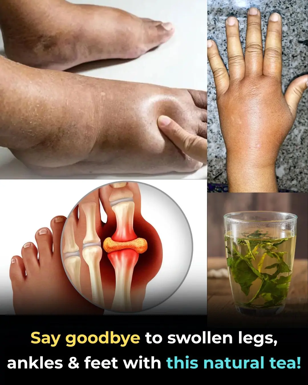 Say Goodbye to Swollen Legs