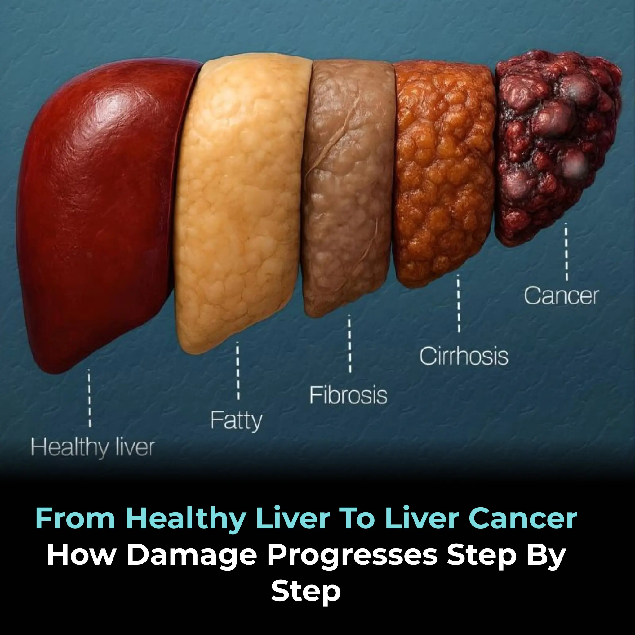 Stages of Liver Damage: From Fatty Liver to Cirrhosis and Cancer