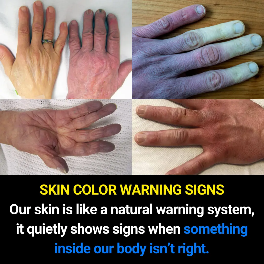 Skin Color Warning Signs: What Changes in Your Skin May Reveal About ...