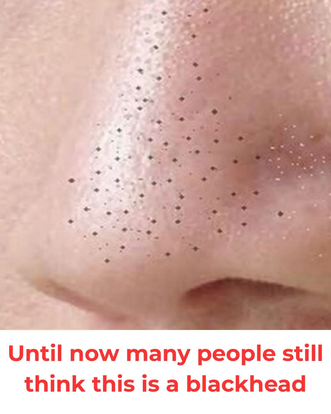Why Those Tiny Dots on Your Nose Are Completely Normal